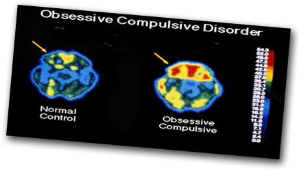 OCD: Obsesssive Compulsive Disorder - Moose and Doc